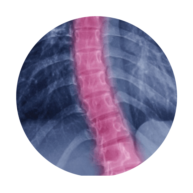 Anterior Scoliosis Correction: Benefits & More! | Advanced Spine