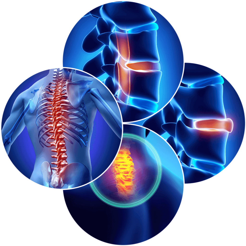 Anterior Cervical Discectomy & Fusion | Advanced Relief