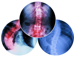 Anterior Scoliosis Correction: Benefits & More! | Advanced Spine