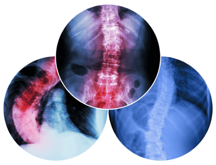 Vertebral Body Tethering (VBT): Benefits & More! | Advanced Spine