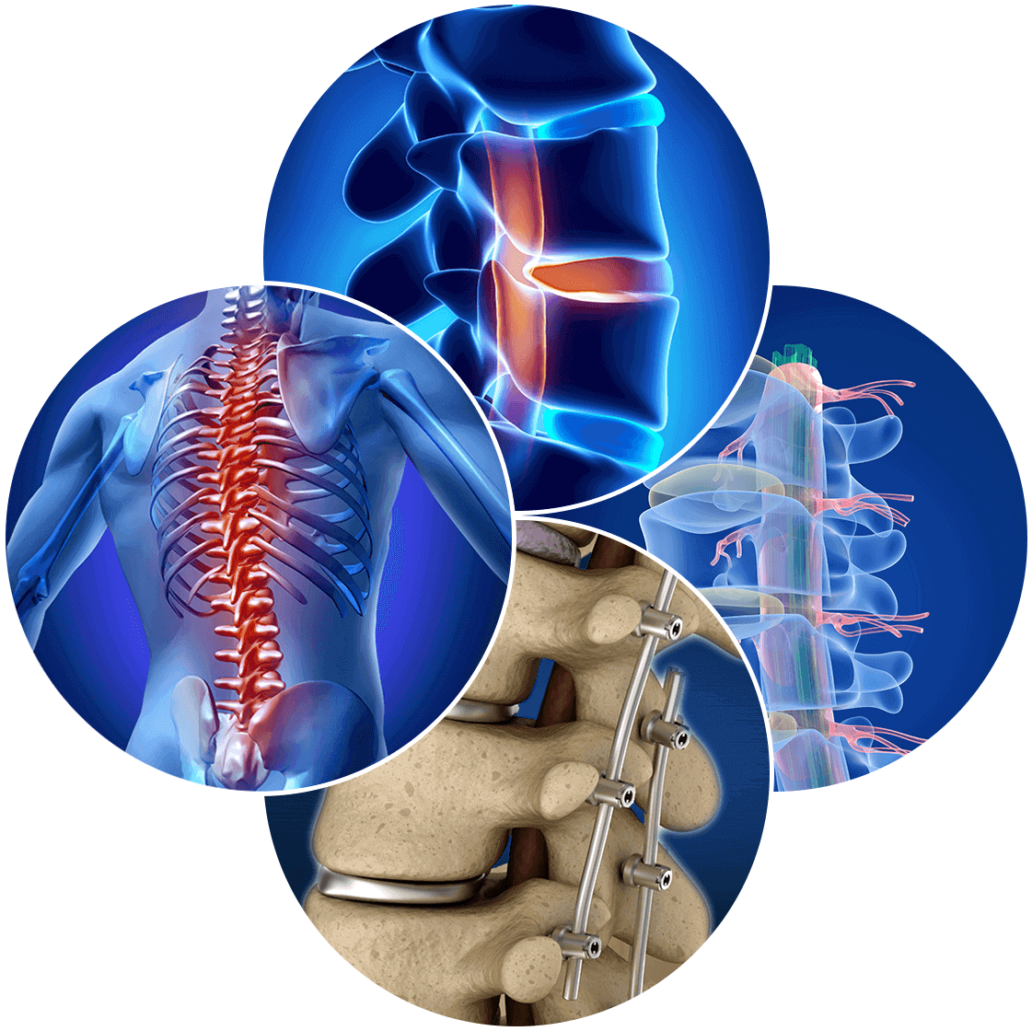 Artificial Disc Replacement, NJ | The Advanced Spine Center