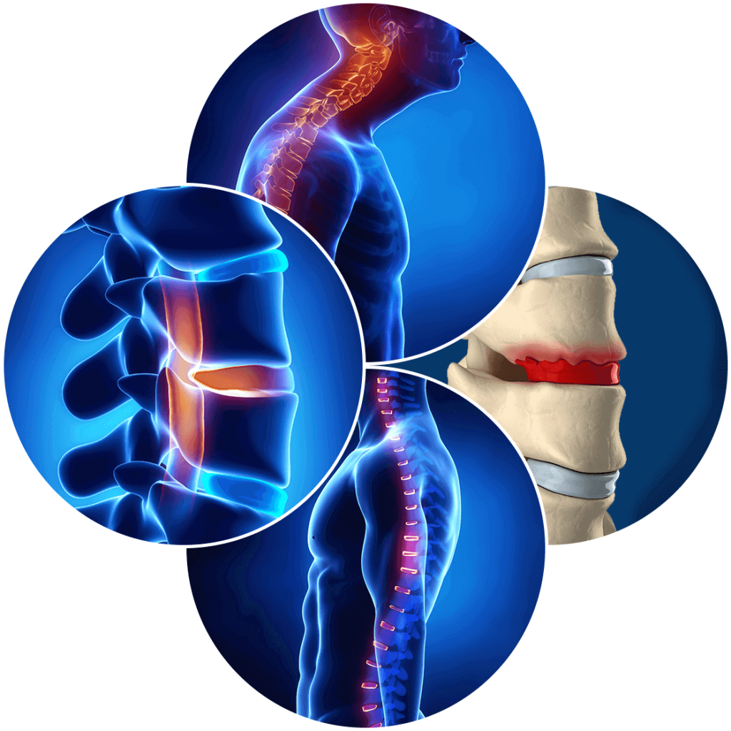 Do I Need a Facetectomy? | The Advanced Spine Center