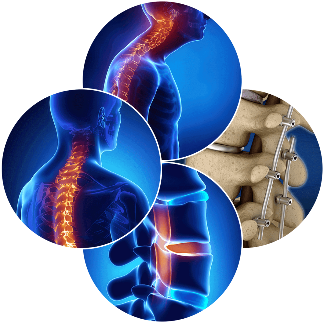 Foraminotomy | Advanced Spine Relief from NJ's Top Docs