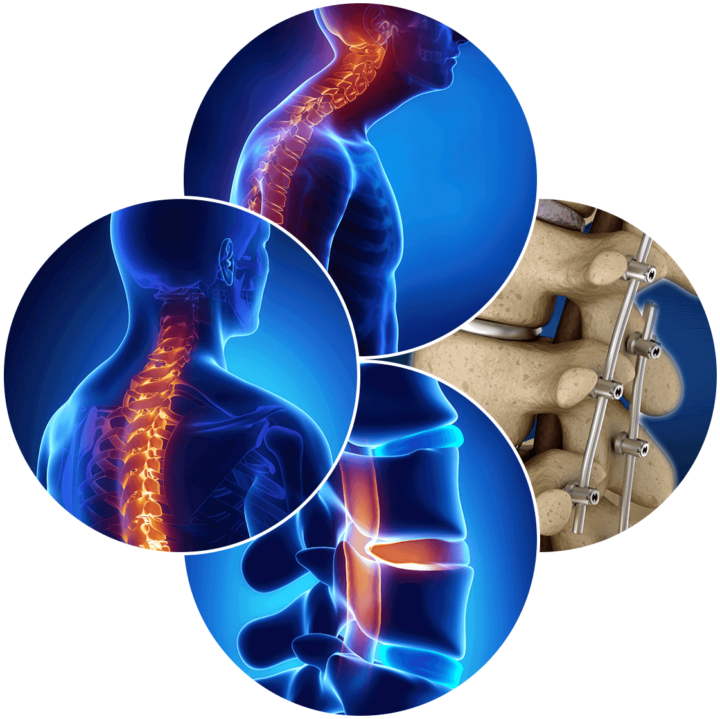 Foraminotomy | Advanced Spine Relief from NJ's Top Docs