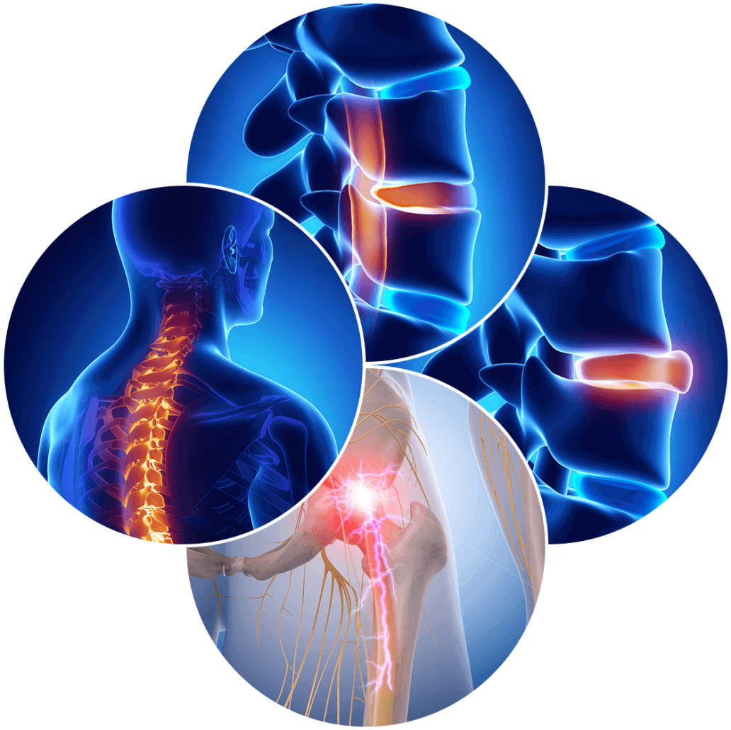 Laminectomy Surgery in NJ & NY | The Advanced Spine Center