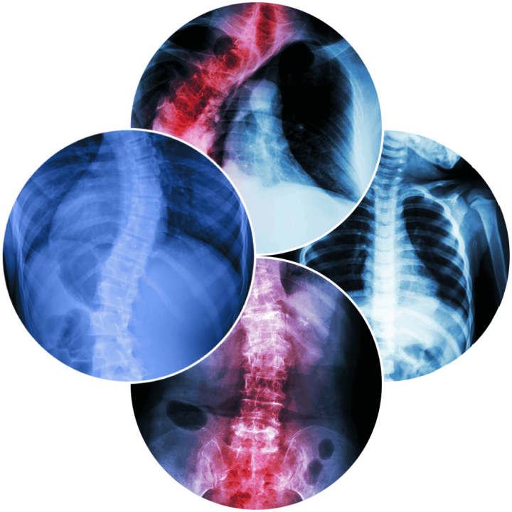 Osteotomy| Advanced Spine Relief from NJ's Top Doctors