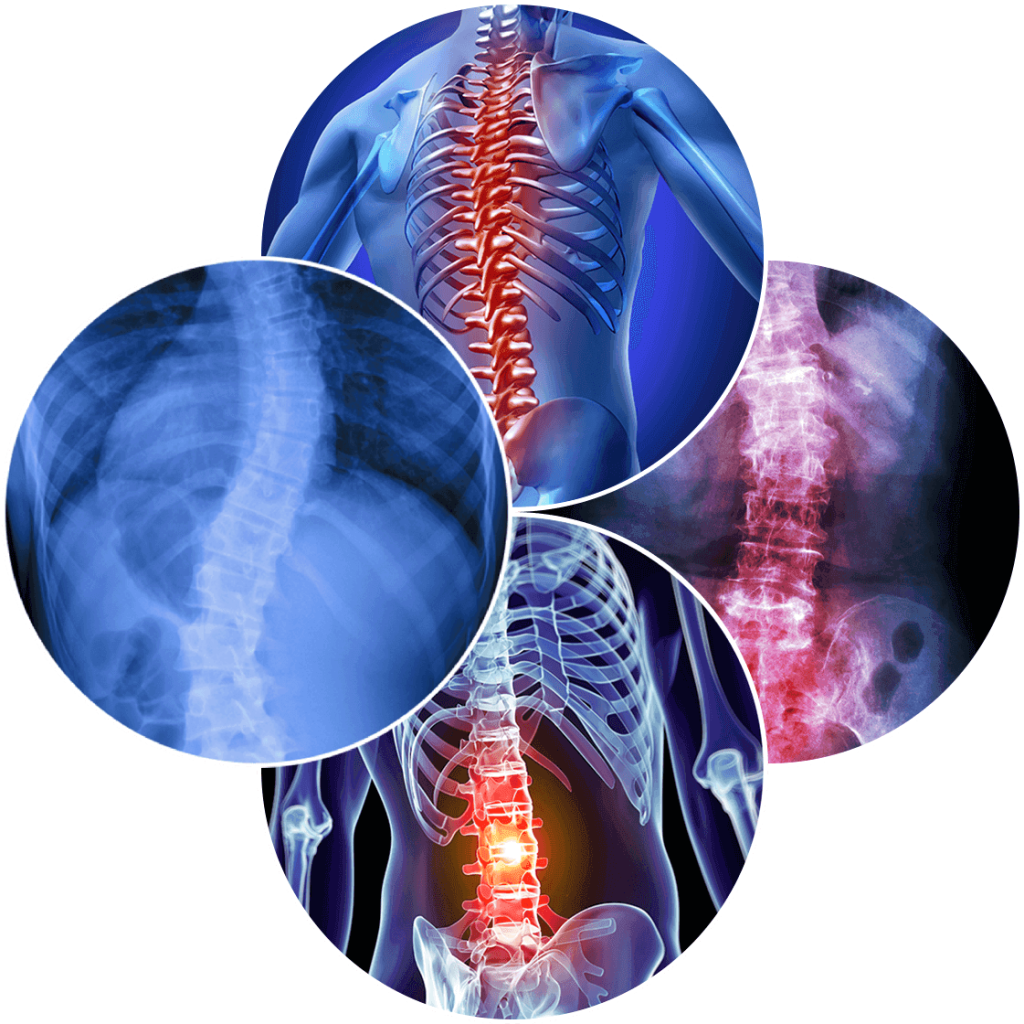 Posterior Lumbar Interbody Fusion | Advanced Spine Relief