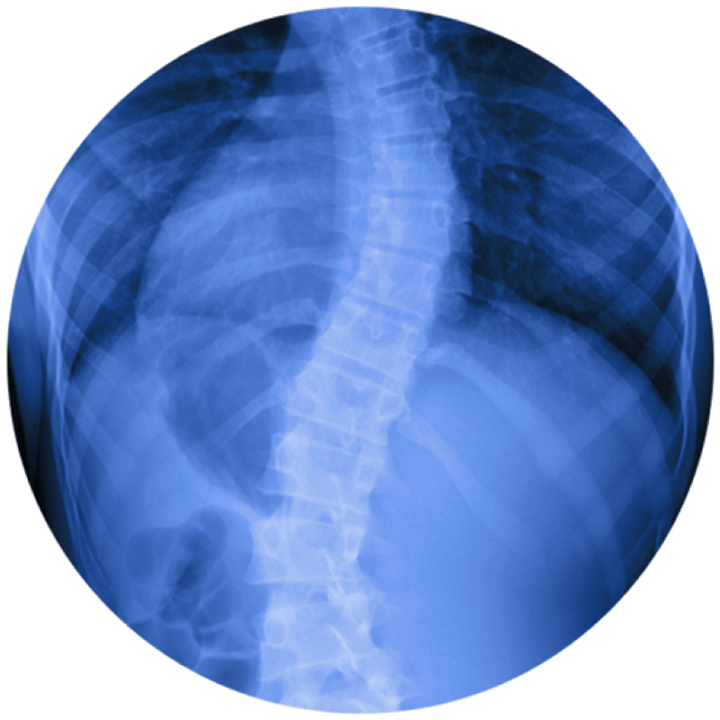 Anterior Scoliosis Correction: Benefits & More! | Advanced Spine