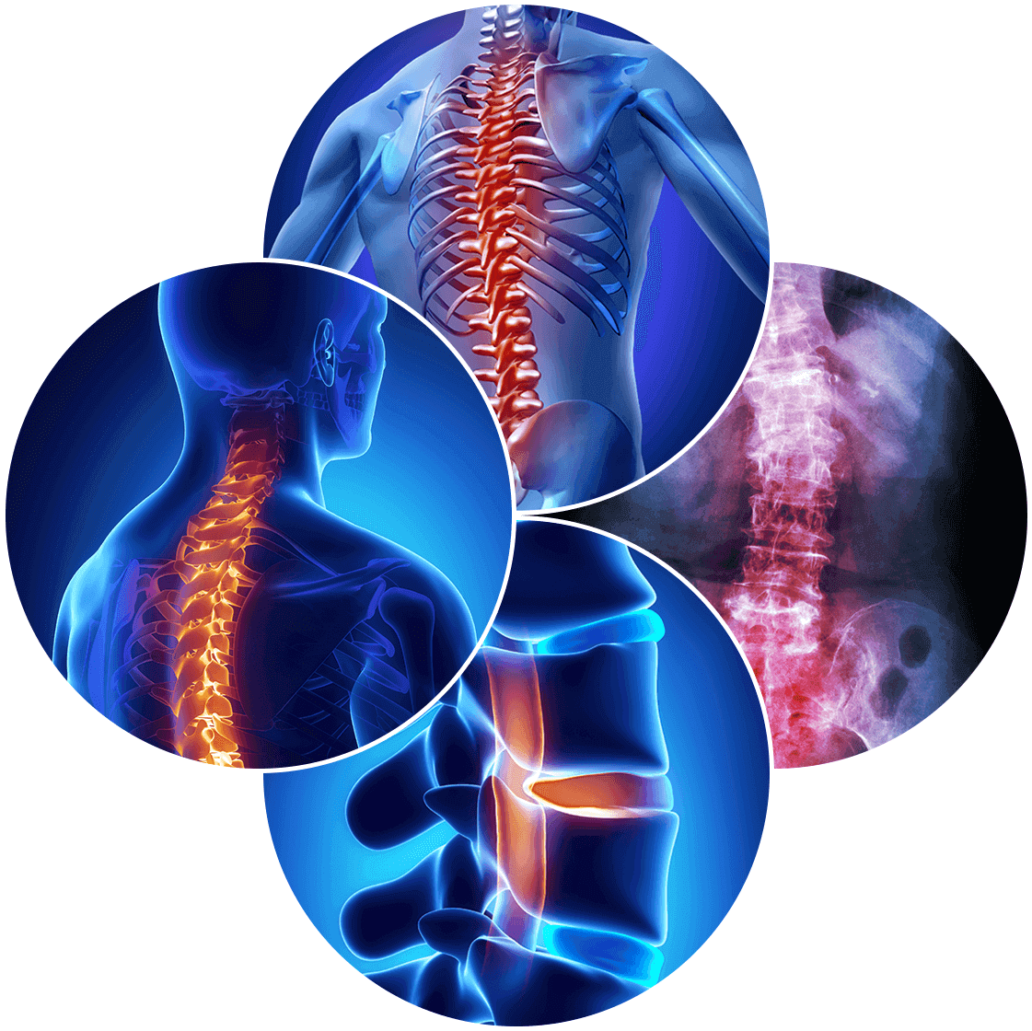Revision Spine Surgery | Advanced Neck & Back Relief