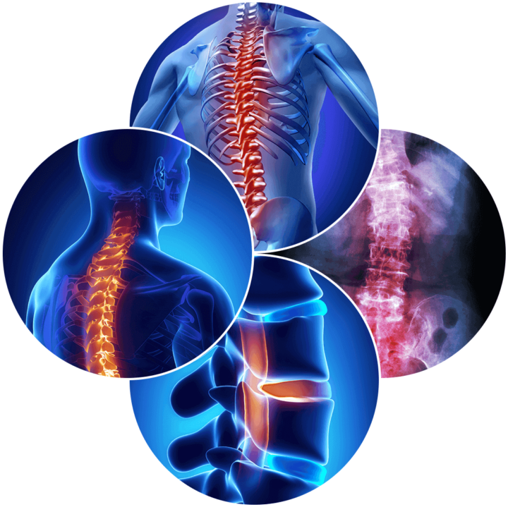 Revision Spine Surgery | Advanced Neck & Back Relief