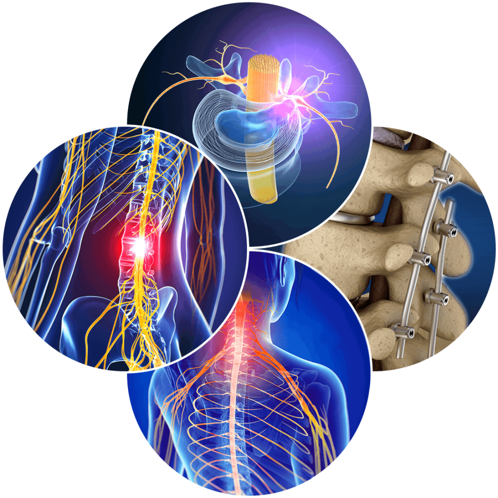 Do I Need a Spinal Cord Stimulator? | The Advanced Spine Center
