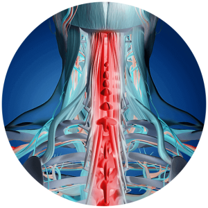 Neck Strains & Sprains | Symptoms & Advanced Spine Care