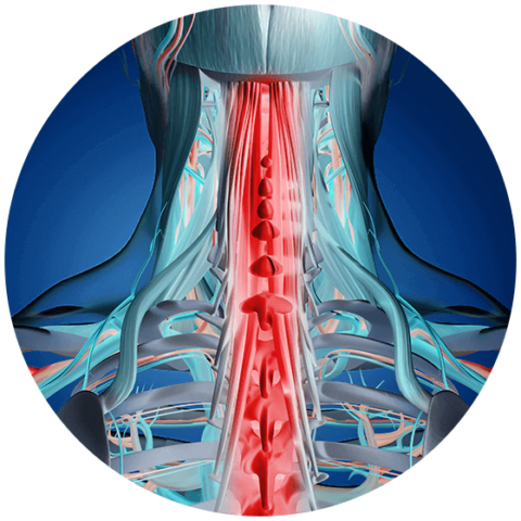 Neck Strains & Sprains | Symptoms & Advanced Spine Care