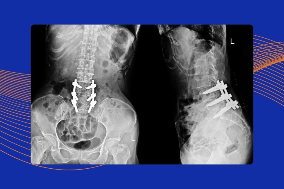 Different Types of Spinal Injuries | Advanced Spine Center