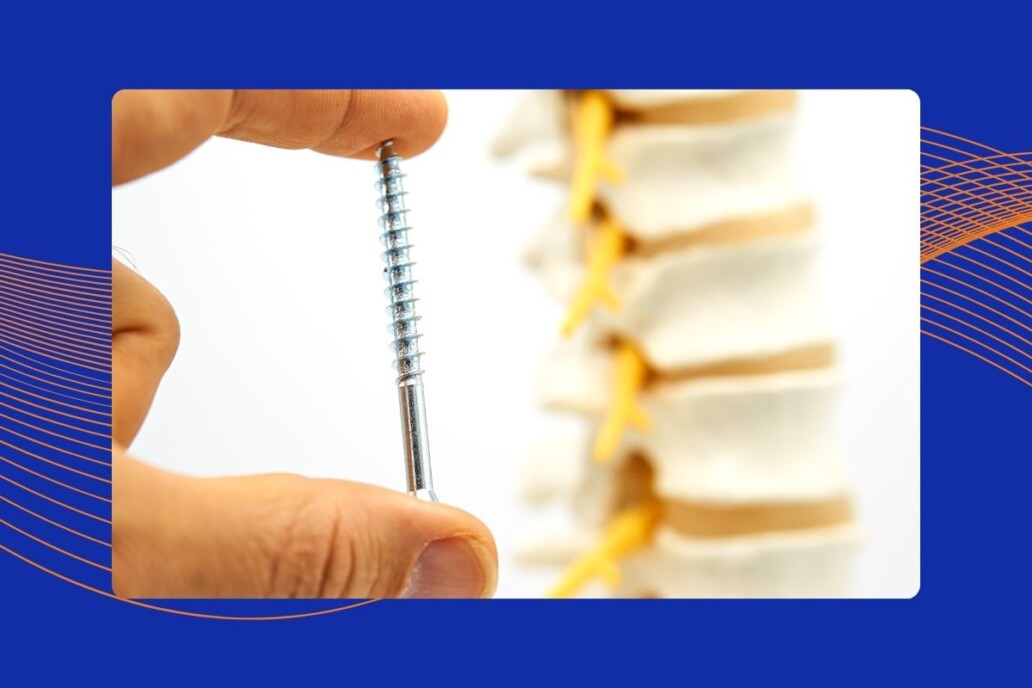 Are Your Spinal Fusion Screws Loose? | Advanced Spine Center